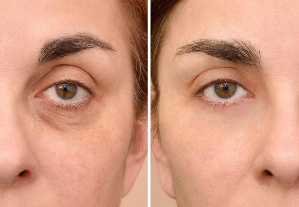 Cómo Eliminar Las Ojeras En Un Día De Manera Efectiva