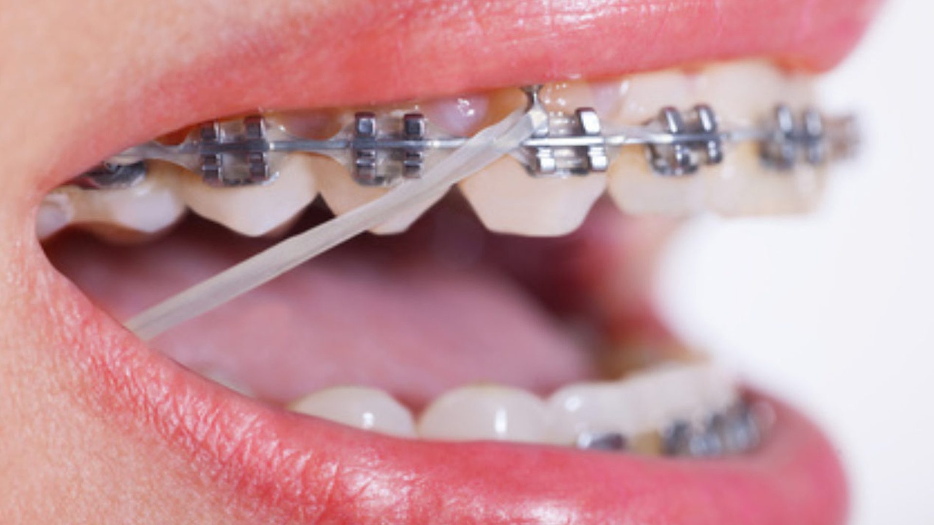 Cómo Se Ponen Las Ligas En Los Brackets Guía Paso A Paso